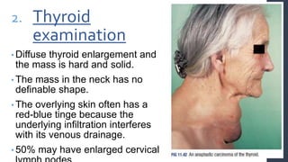Undifferentiated thyroid carcinoma | PPTX