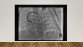 Unexpected Complication in The Cath Lab.pptx