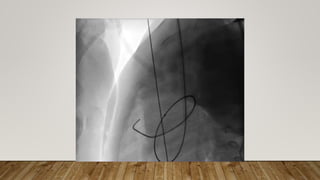 Unexpected Complication in The Cath Lab.pptx