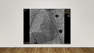 Unexpected Complication in The Cath Lab.pptx