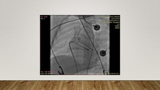 Unexpected Complication in The Cath Lab.pptx