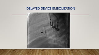 Unexpected Complication in The Cath Lab.pptx