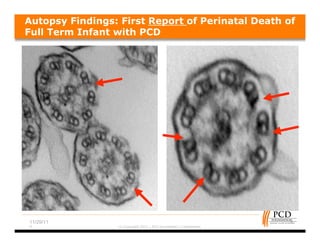 Unexplained Death in Children, the Role of Genetics and Biobanking | PDF