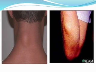 Unexplained lumps | PPTX