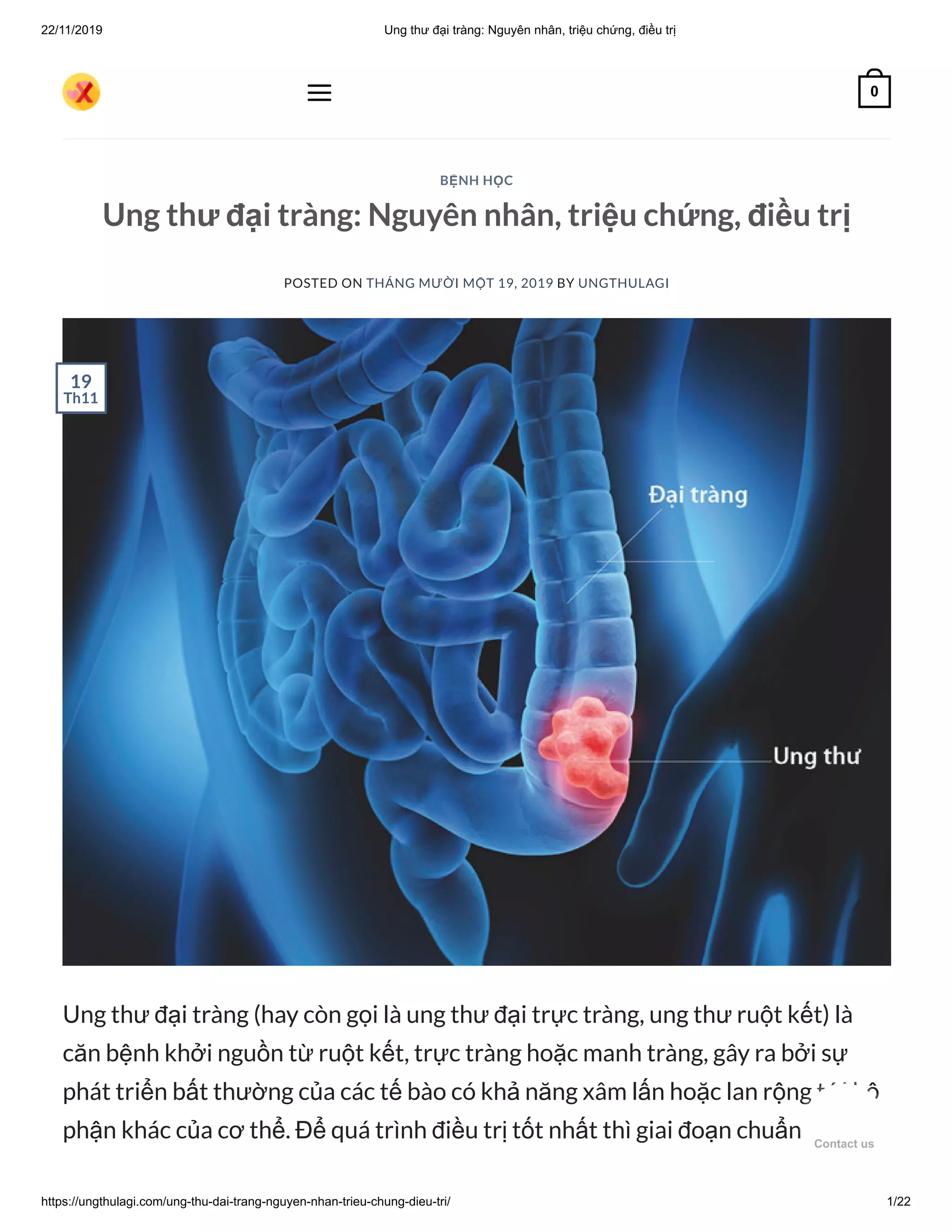 Ung thu dai trang nguyen nhan dau hieu trieu chung phuong phap dieu tri hieu qua nhat | PDF