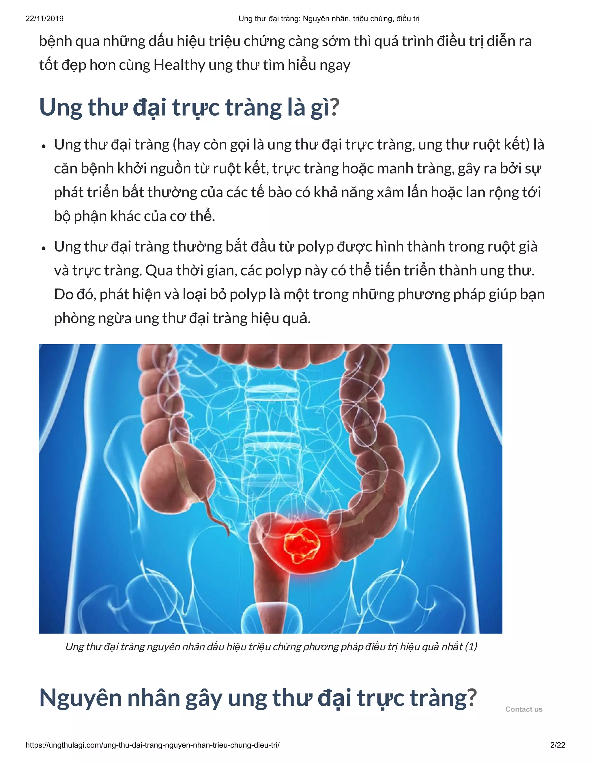 Ung thu dai trang nguyen nhan dau hieu trieu chung phuong phap dieu tri hieu qua nhat | PDF