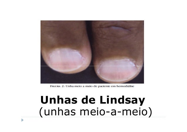 Anormalidades das Unhas - GESME - Profa. Rilva Lopes de Sousa-Muñoz