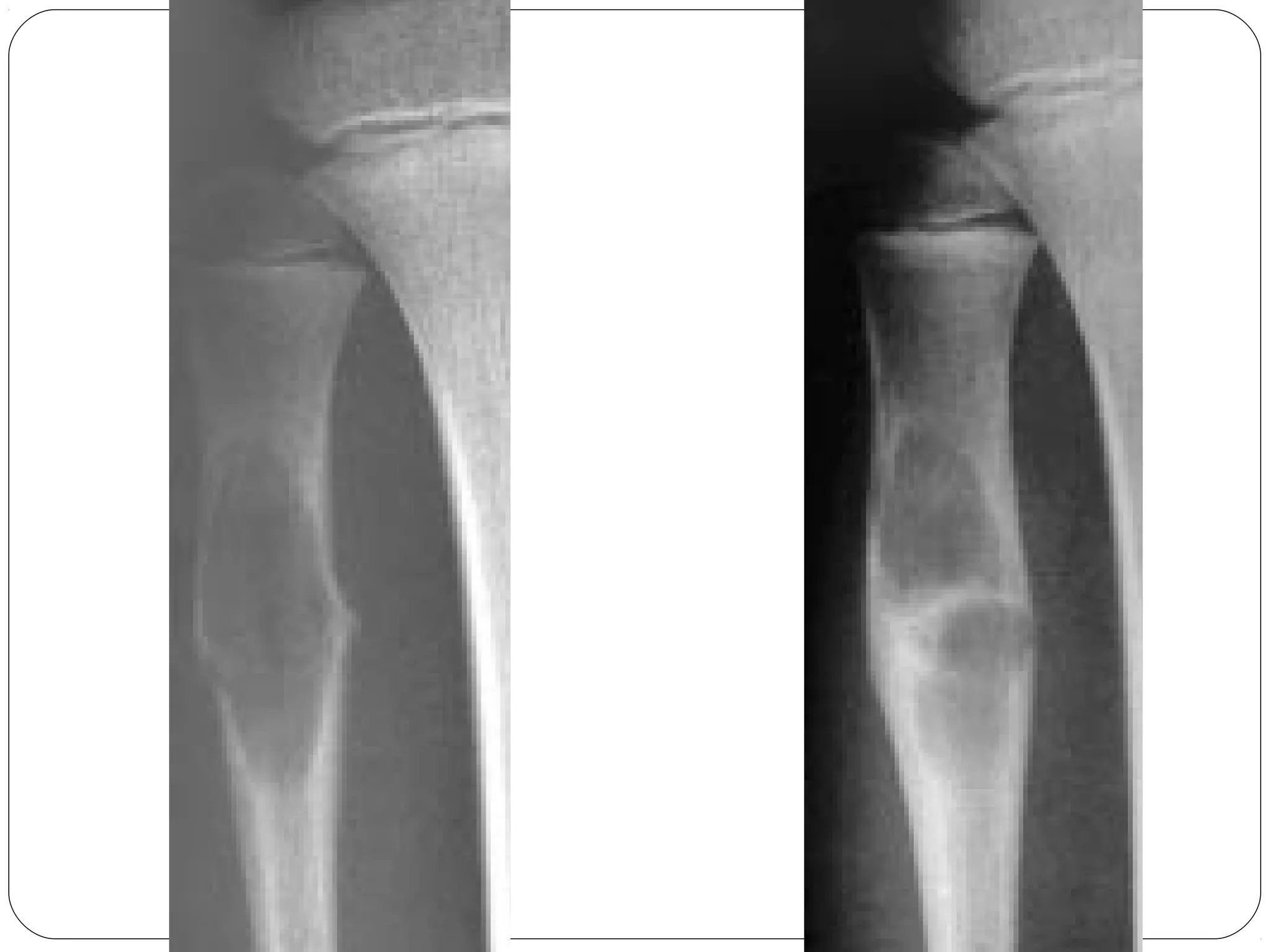 Unicameral bone cysts | PPT