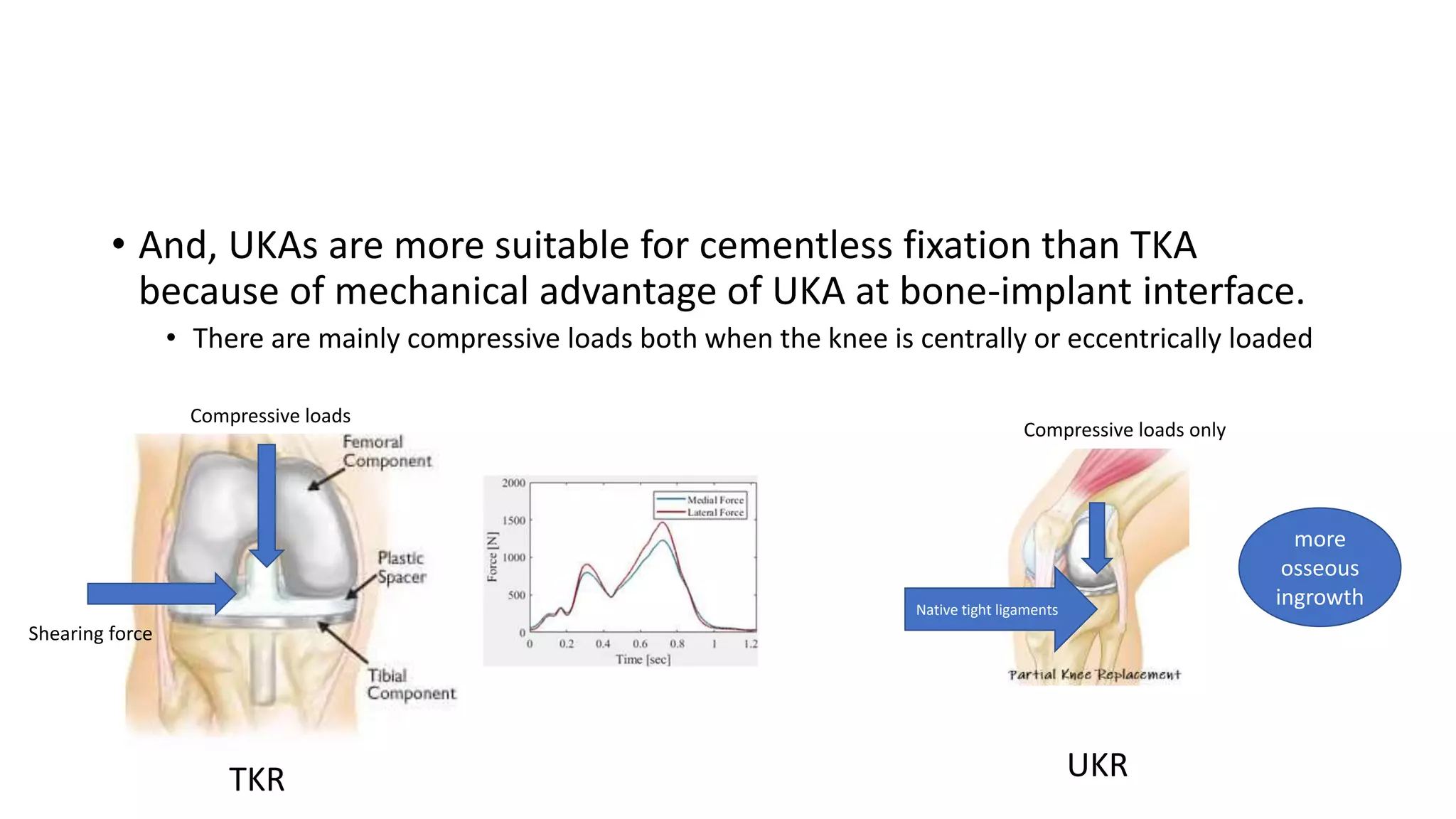 Unicompartmental knee arthroplasty | PPTX