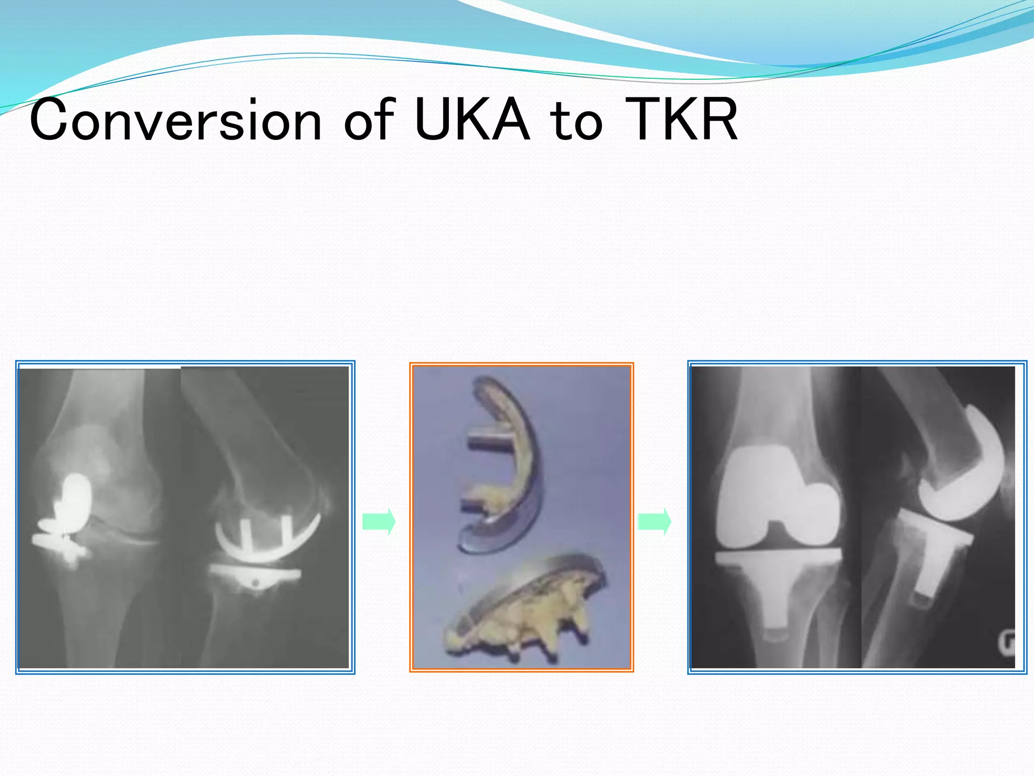 Unicondylar knee replacement | PPTX
