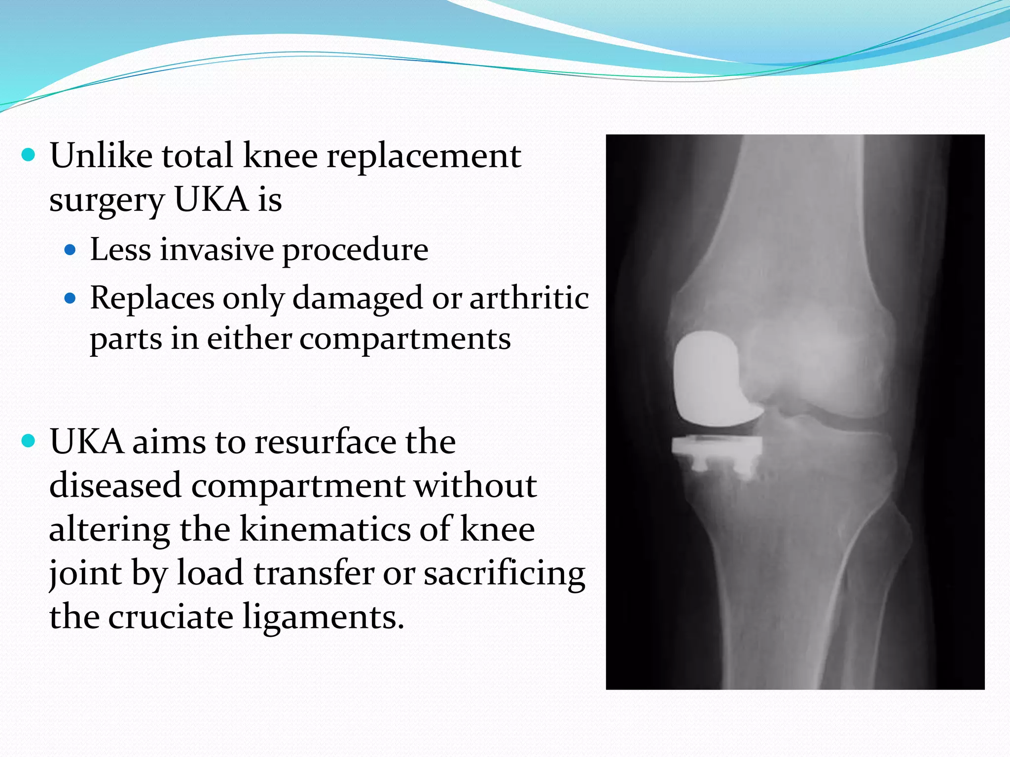 Unicondylar knee replacement | PPTX