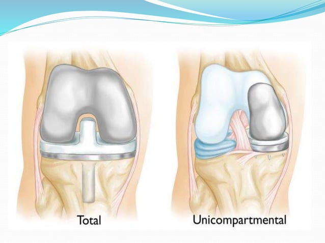 Unicondylar knee replacement | PPTX