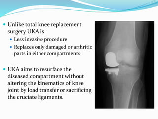 Unicondylar knee replacement | PPTX