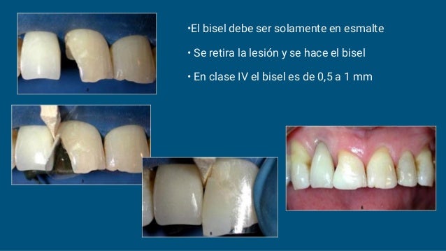 UNIDAD VI ODONTOLOGÍA ADHESIVA