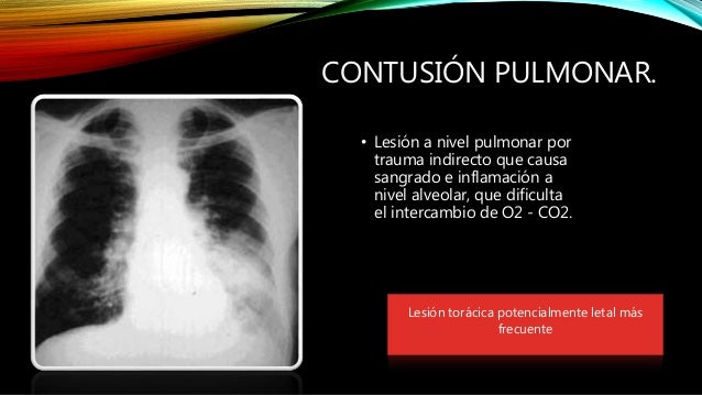 Contusion Pulmonar