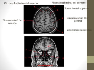 Protocolo cerebro en resonancia magnetica | PPTX
