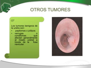 Unidad n° 4 PROCEDIMIENTOS QUIRÚRGICOS EN URETRA | PPTX