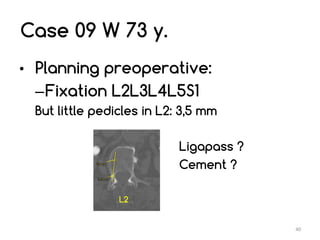 My UNID experience in lumbar arthrodesis for degenerative spine ...