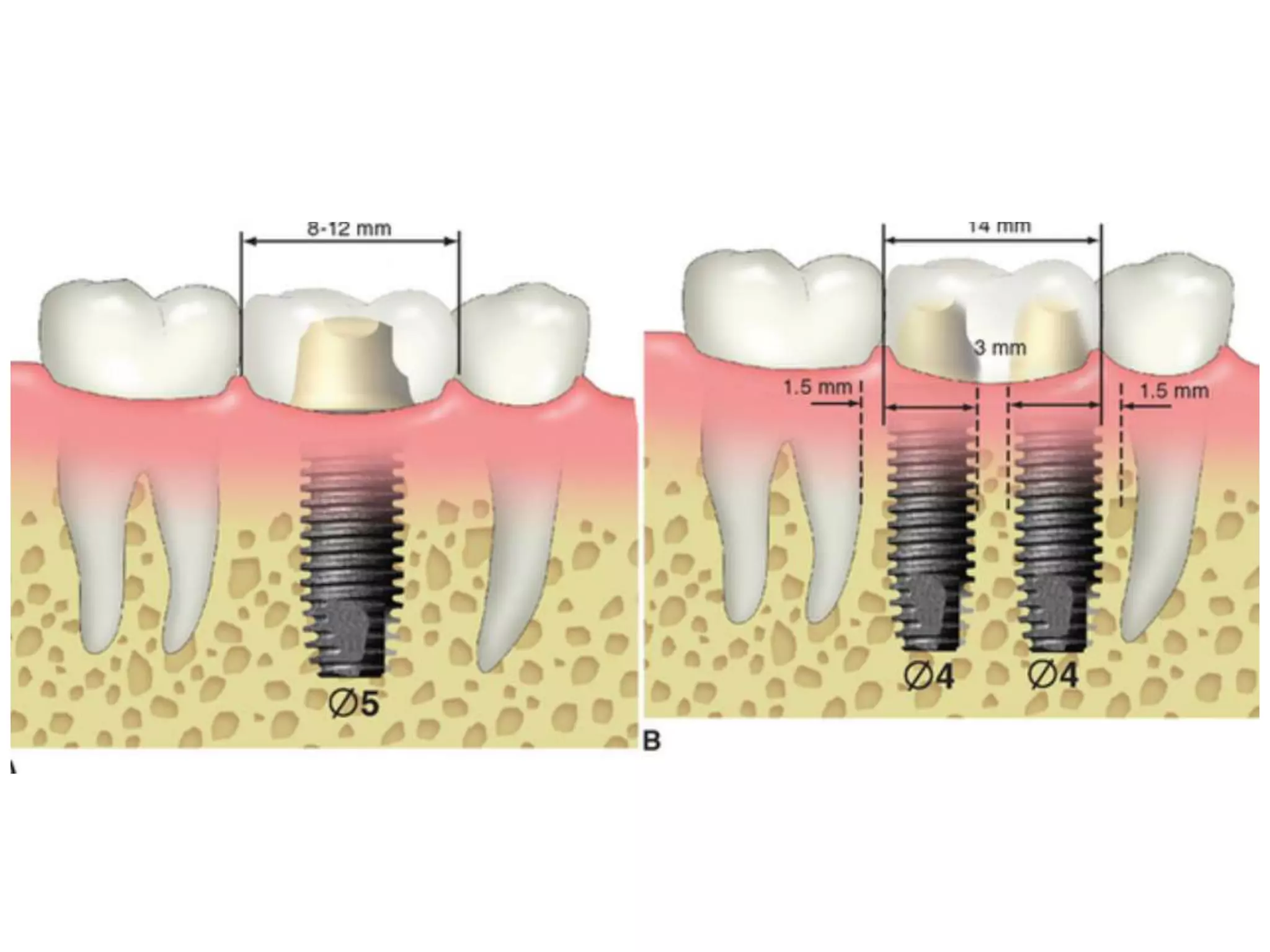 Dental implant principles | PPTX
