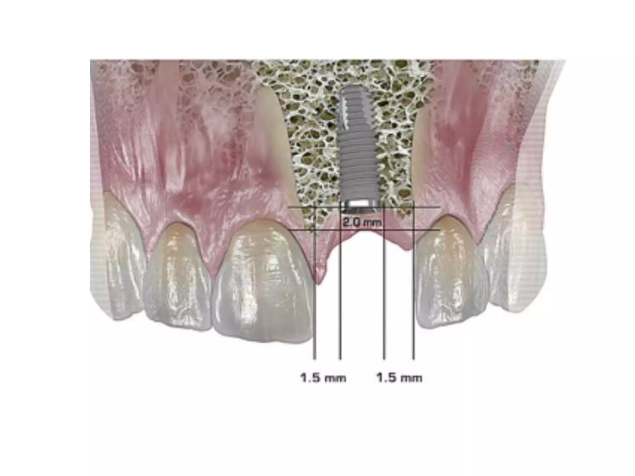 Dental implant principles | PPTX