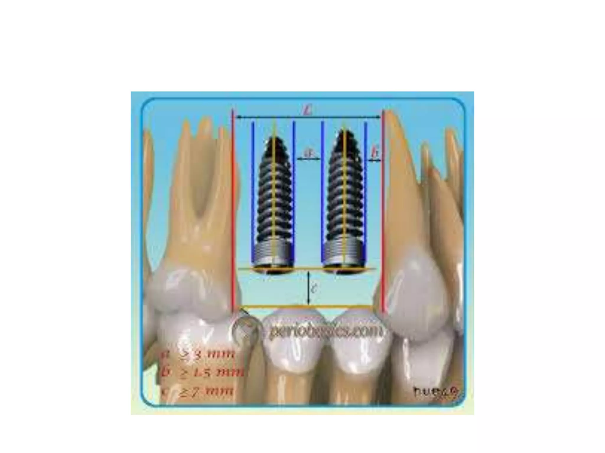 Dental implant principles | PPTX