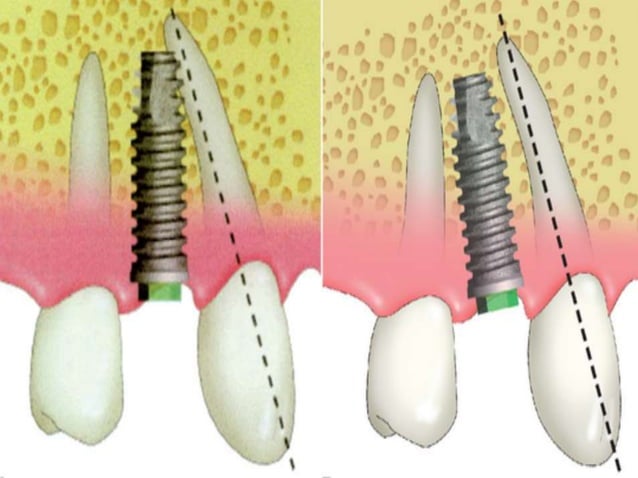 Dental implant principles | PPTX