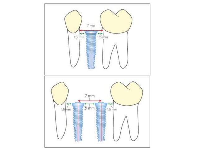Dental implant principles | PPTX