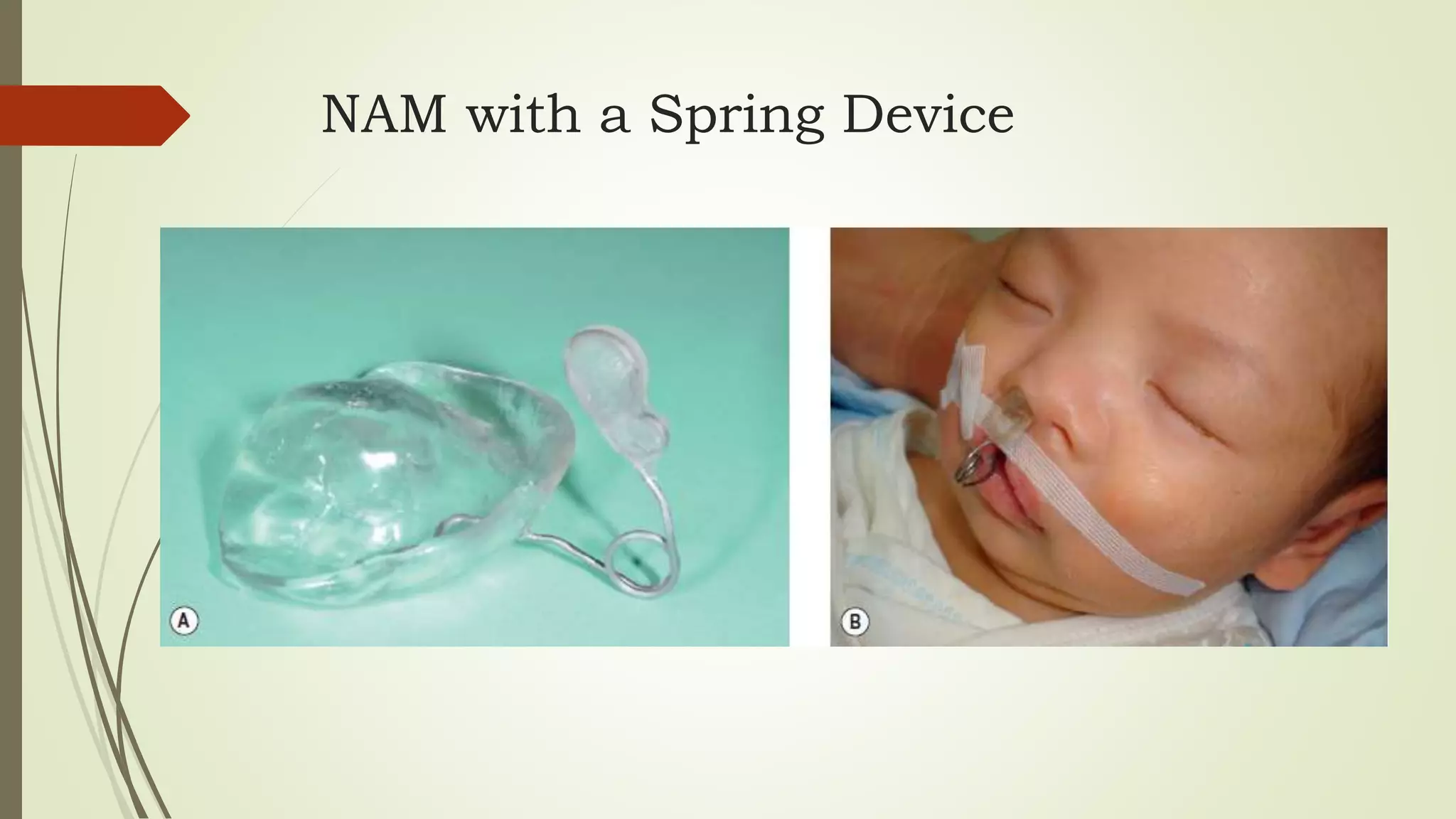 Unilateral cleft lip | PPTX