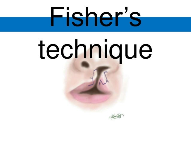 Outcomes of primary unilateral cheiloplastyin same-day surgical setti…