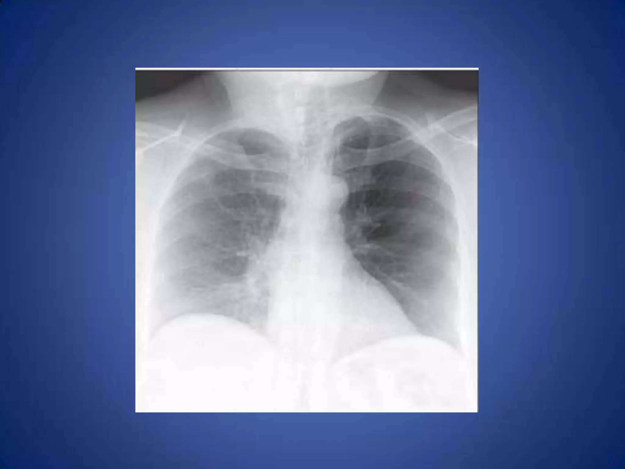 Unilateral hyperlucent hemithorax | PDF