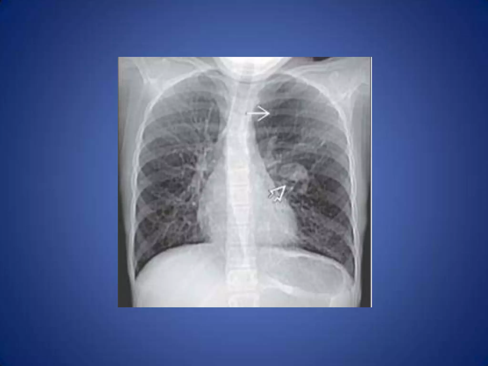 Unilateral hyperlucent hemithorax | PDF
