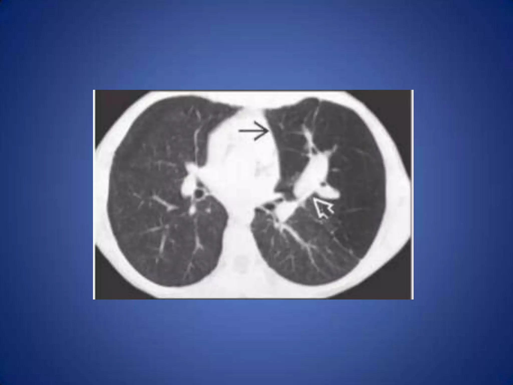 Unilateral hyperlucent hemithorax | PDF