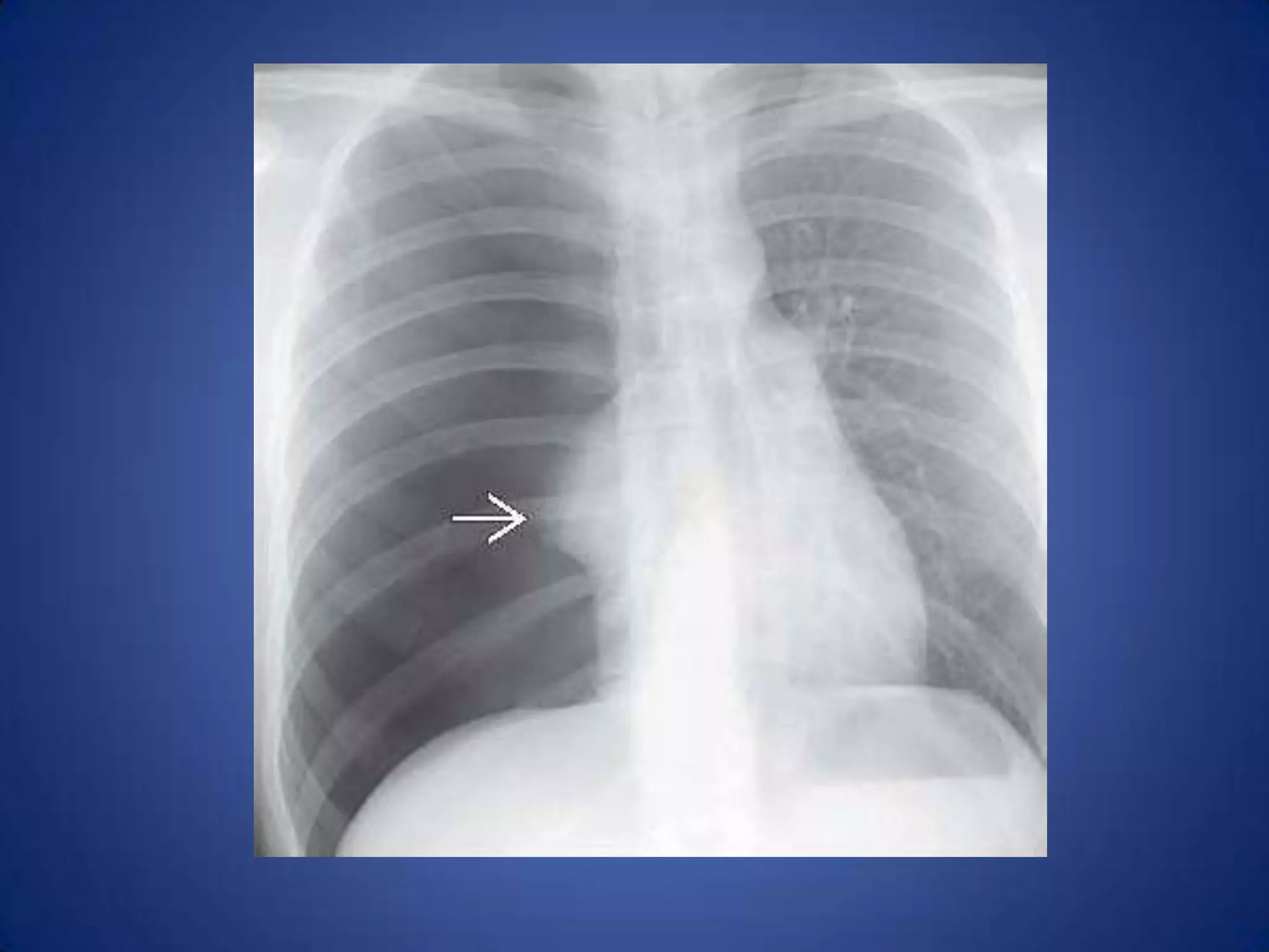 Unilateral hyperlucent hemithorax | PDF