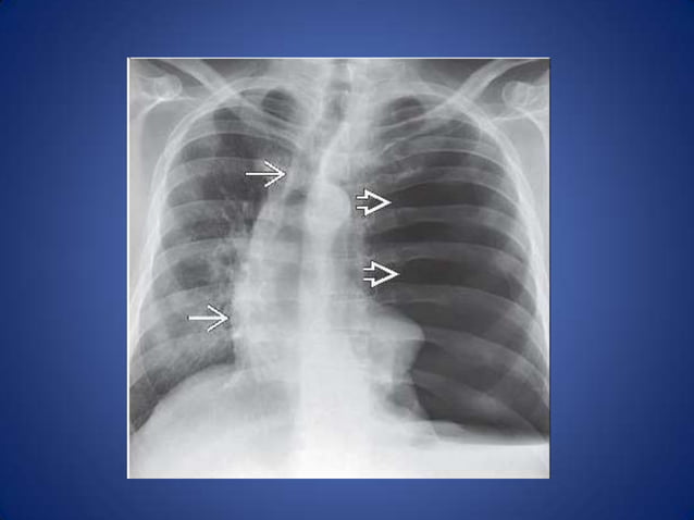 Unilateral hyperlucent hemithorax | PDF | Lung and Respiratory Health ...