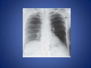 Unilateral hyperlucent hemithorax | PDF