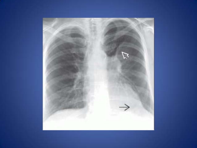 Unilateral hyperlucent hemithorax | PDF | Lung and Respiratory Health ...