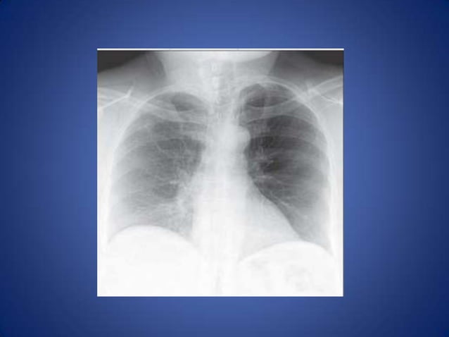 Unilateral hyperlucent hemithorax | PDF | Lung and Respiratory Health ...