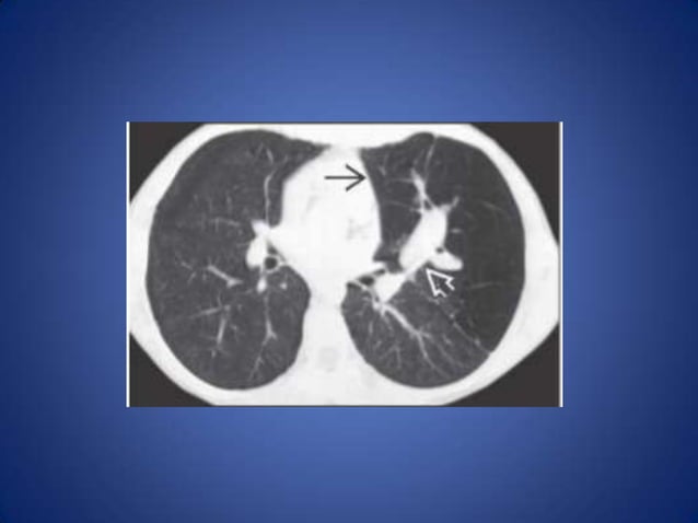 Unilateral hyperlucent hemithorax | PDF | Lung and Respiratory Health ...
