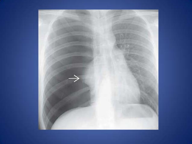 Unilateral hyperlucent hemithorax | PDF | Lung and Respiratory Health ...