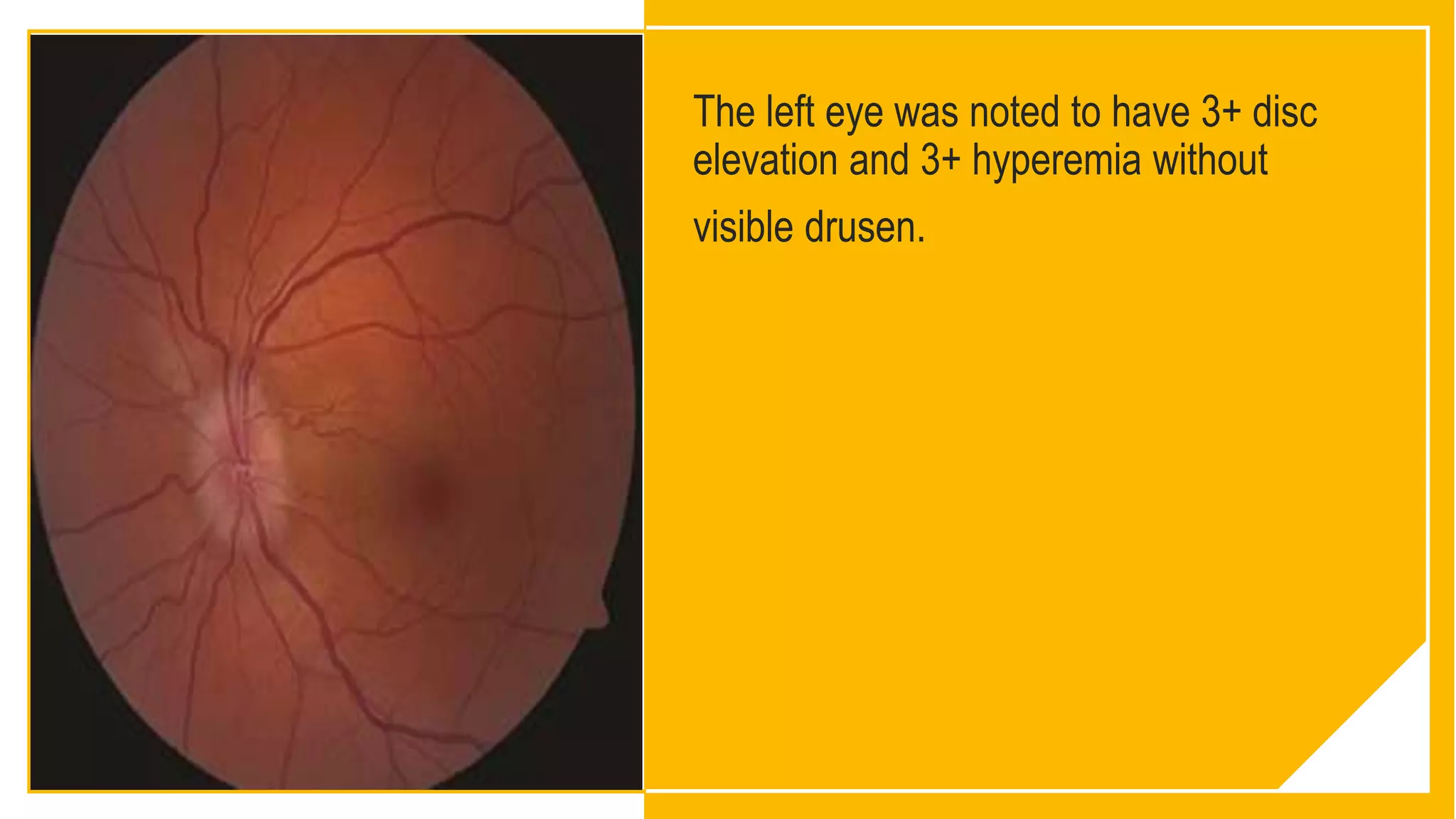 Unilateral Optic disc swelling | PPTX