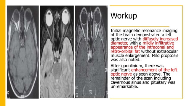 Unilateral Optic Disc Swelling Ppt
