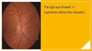 Unilateral Optic disc swelling | PPTX