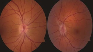 Unilateral Optic disc swelling | PPTX
