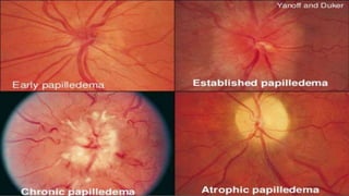 Unilateral Optic disc swelling | PPTX