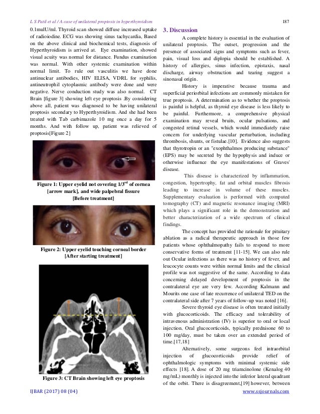 Unilateral proptosis in hyperthyroidism