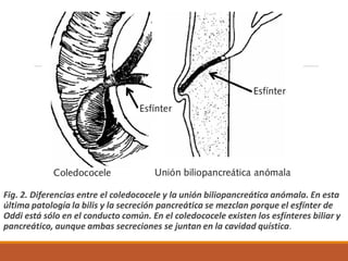 Union pancreatobiliar anomala. dr. miguel chávez r | PDF