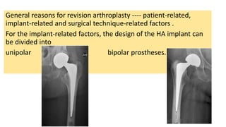 Bipolar Hemiarthroplasty Vs Total Hip Replacement