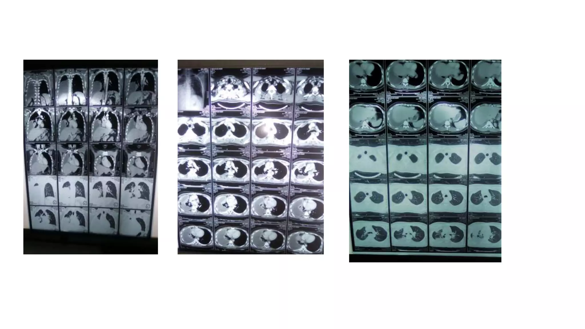 open vs VATS decortication | PPTX | Physical Therapy | Wellness