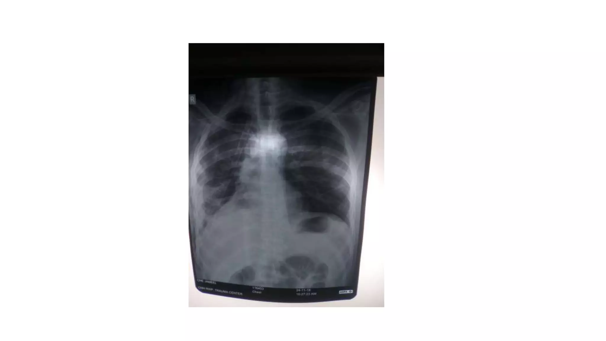 open vs VATS decortication | PPTX | Physical Therapy | Wellness