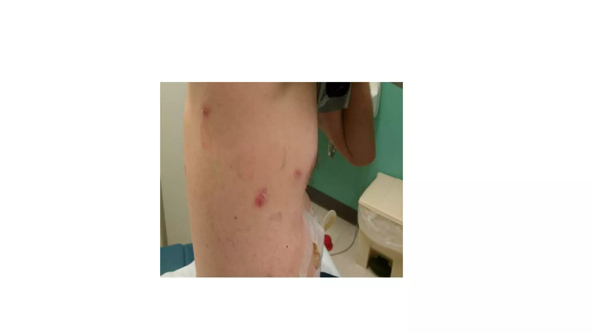 open vs VATS decortication | PPTX | Physical Therapy | Wellness